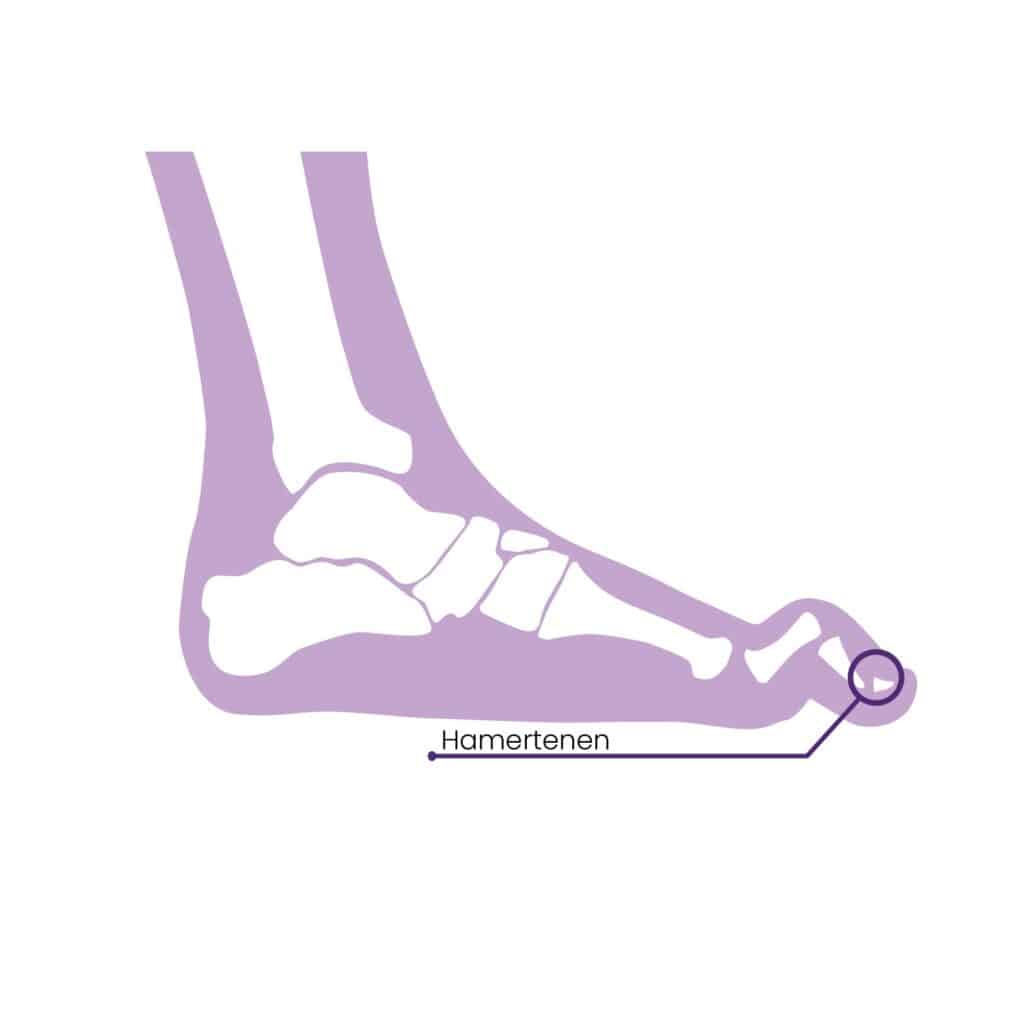Hamerteen: Oorzaak & Behandeling | Podotherapie Hermanns