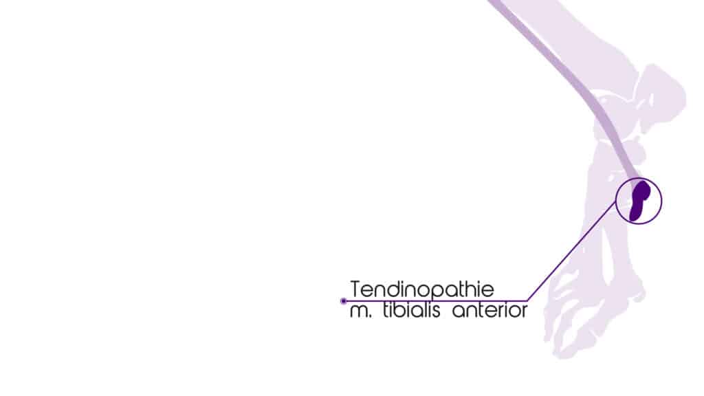 Podotherapie Hermanns | ontsteking scheenbeenspier, ontsteking ...