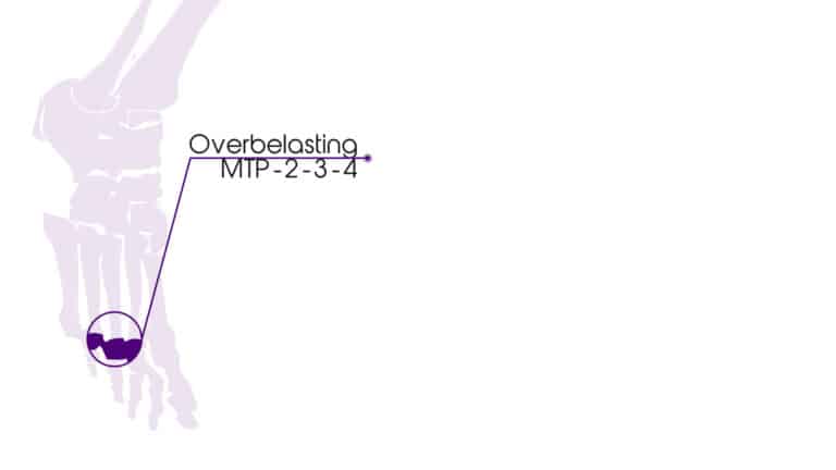 Capsulitis: Oorzaak & Behandeling | Podotherapie Hermanns