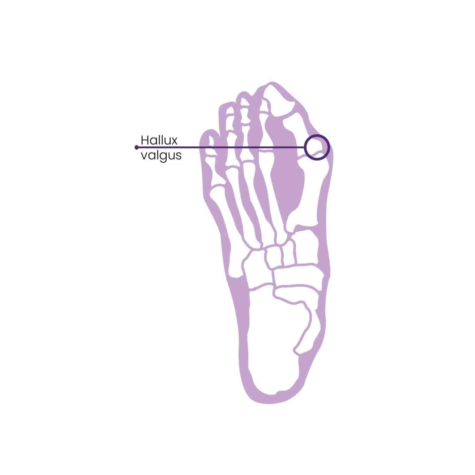 Hallux Valgus: Oorzaken & Behandeling | Podotherapie Hermanns