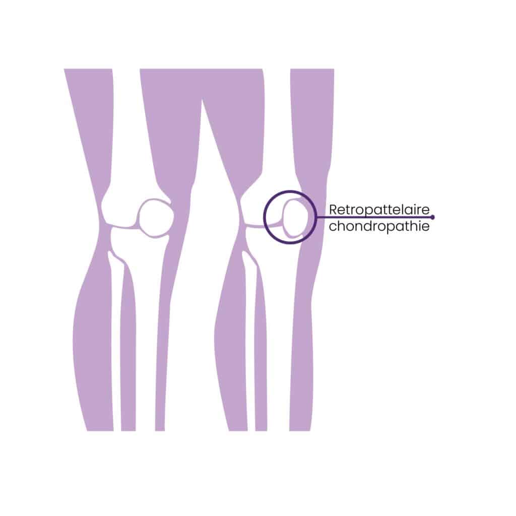 Pijn knieschijf | Podotherapie Hermanns