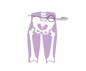 Podotherapie Hermanns | bekkenscheefstand, bekkenscheefstand behandelen ...