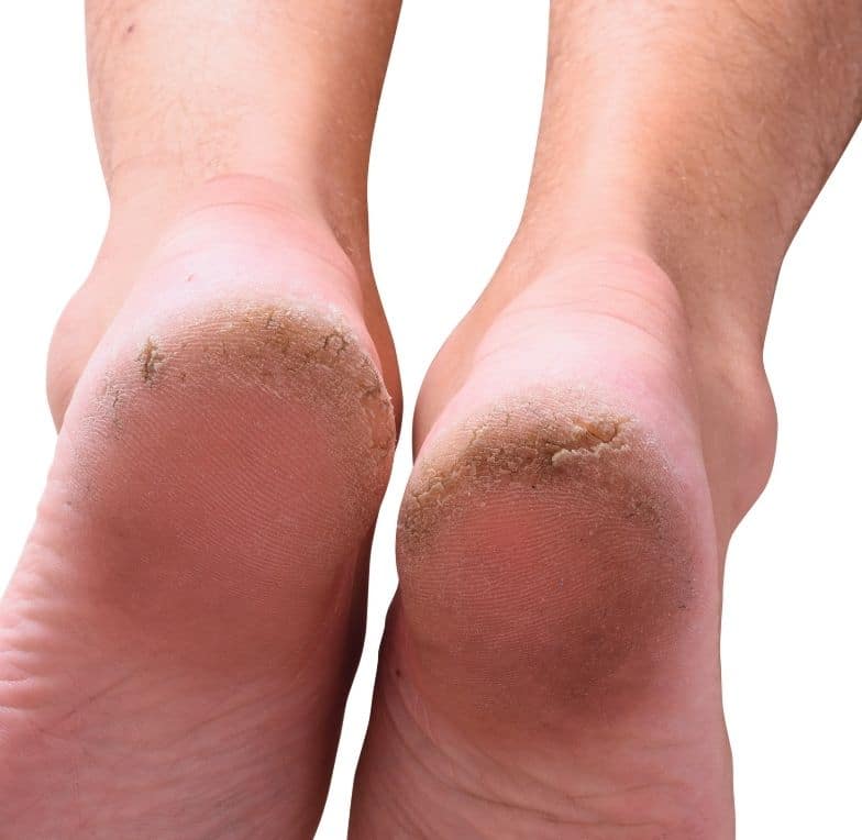 Podotherapie Hermanns | Eelt voet, eelt voet verwijderen, eelt voet ...