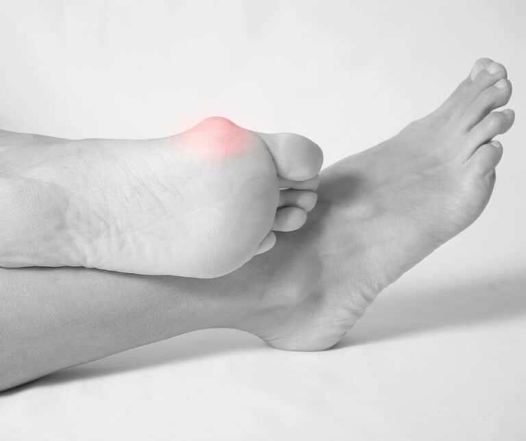 Hallux Valgus: Oorzaken & Behandeling | Podotherapie Hermanns